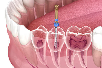 Urgent Root Canal Help - Find a Dentist for Emergency Dental Care